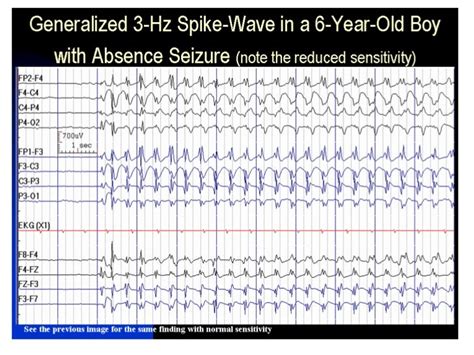 abnormal eeg patterns