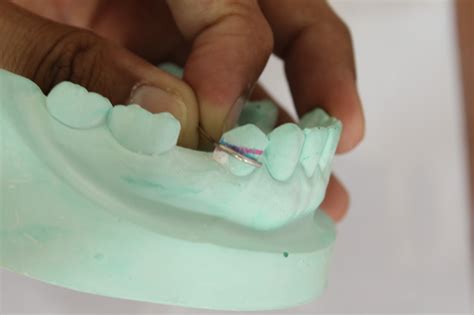 Step By Step Guide For Understanding The Prosthodontics Making Clasp