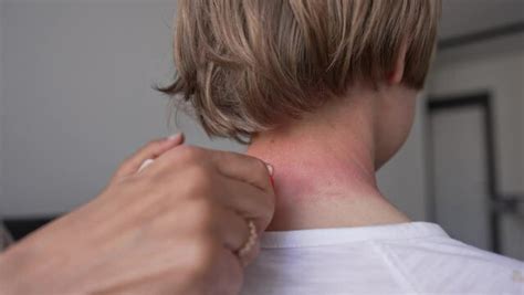 Photodermatitis Video Footage Browse 20 Hd Stock Video And Footage