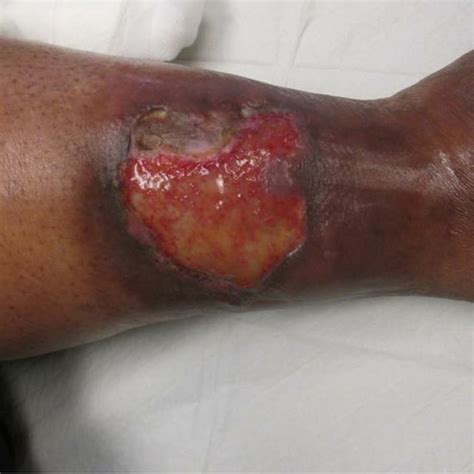 Pyoderma Gangrenosum Patients Right Lower Leg Lesion At Presentation