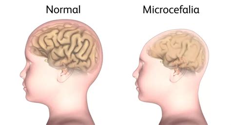 Microcefalia Qué Es Y Consecuencias Para La Vida Del Niño