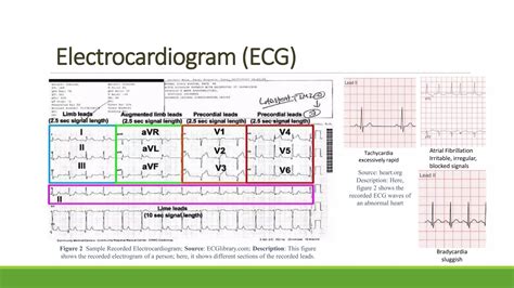 Non Invasive Point Of Care Ecg Signal Detection And Analytics For Cardiac Diseases 180107058