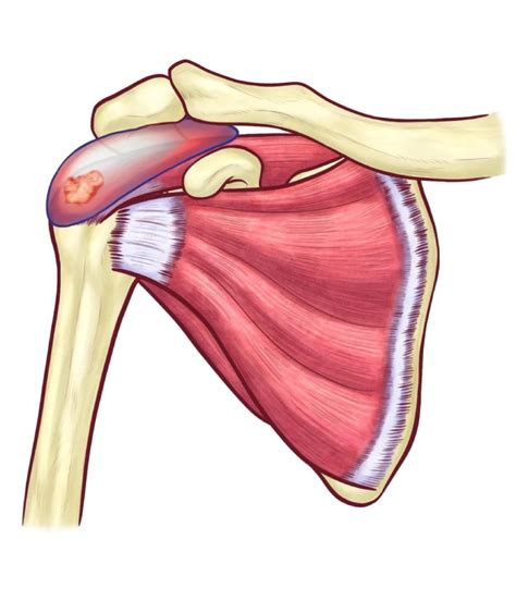 Shoulder Tendonitis Treatment Singapore Dr Bryan Tan