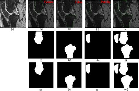Figure 2 From Fully Automatic Knee Bone Detection And Segmentation On
