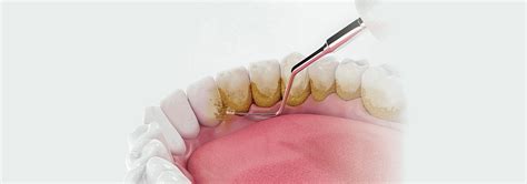 Tartar Vs Plaque Key Differences And Oral Health Implications