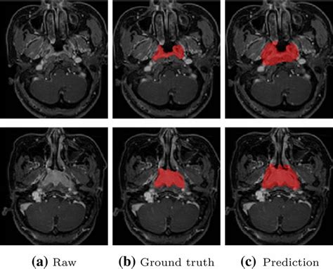 Predicted Results Of Some Samples Using Weighted Cross Entropy The