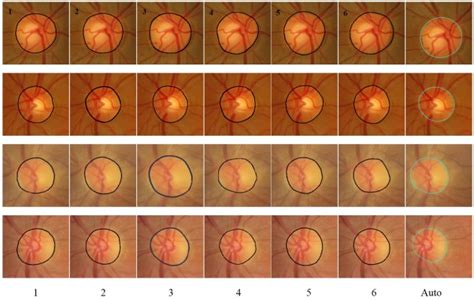 optic disc segmentation for glaucoma screening system using fundus ima