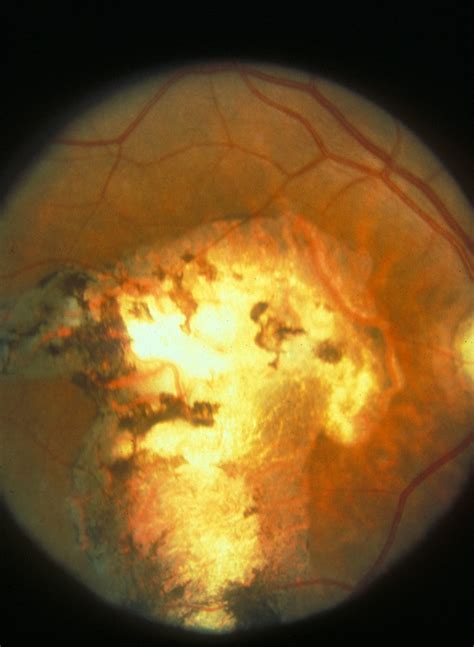 Toxoplasmose Ocular Sintomas Diagnóstico E Tratamento