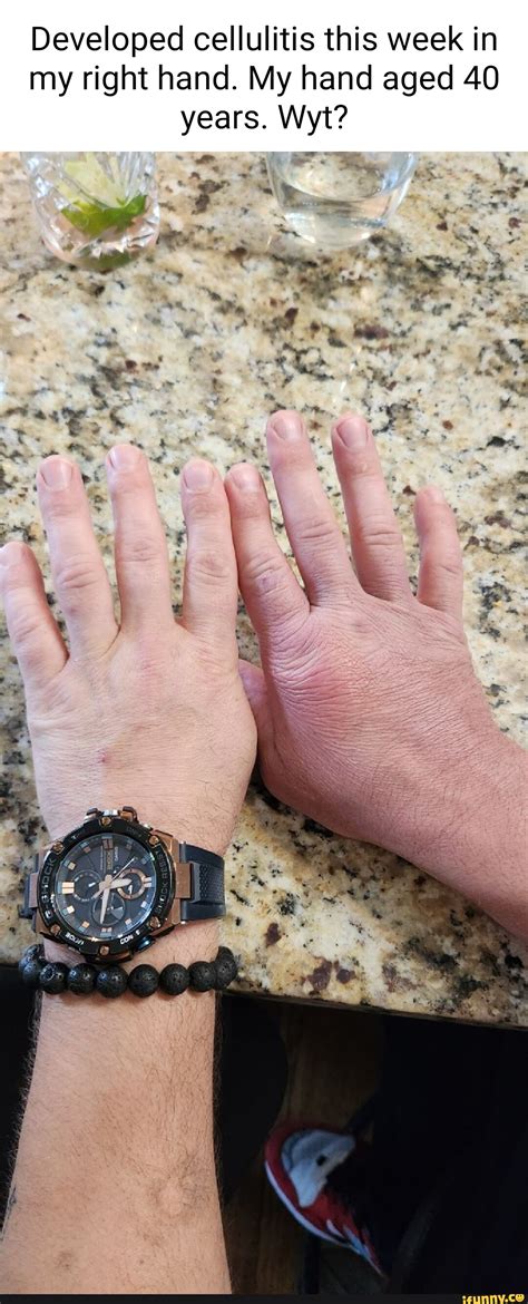 Developed Cellulitis This Week In My Right Hand My Hand Aged 40 Years
