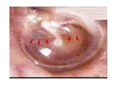 Nonsuppurative Otitis Media Pptx