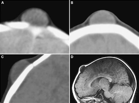 Figure 3 From Subgaleal Dermoid Tumors At The Anterior Fontanelle