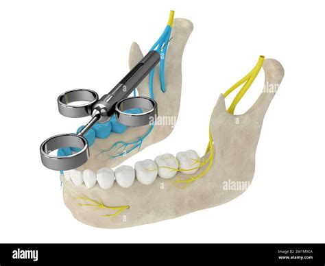 3d Render Of Mandibular Arch With Gow Gates Nerve Block Types Of