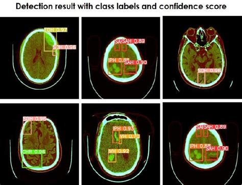 Figure 2 From An Efficient Detection Of Intracranial Hematoma Using