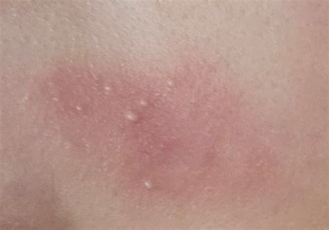 얼굴에 뭐가 났어요 지식in