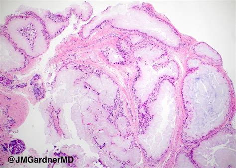 Jerad Gardner Md 12cm Subcutis Mass Back Of Middle Aged Woman Mdm2