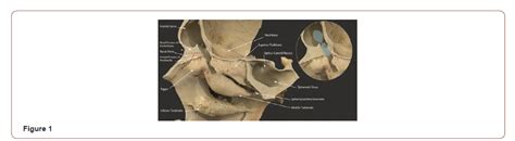 Anatomy Of Frontal Recess And Opening
