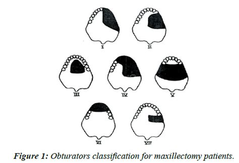 Maxillary Obturator In Hemi Maxillectomy Patient A Case Report