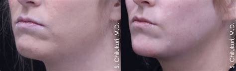 Chin Augmentation Archives Refresh Dermatology