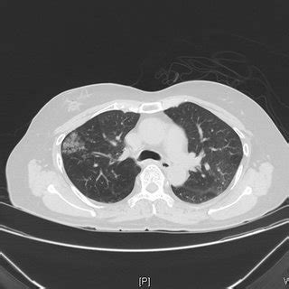 PDF Lung Cancer Detection System Using Image Processing And Machine Learning Techniques