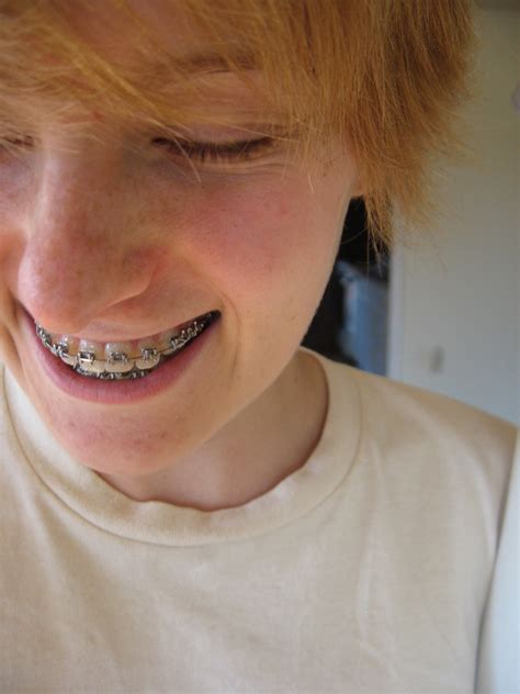 Braces Its Rebecca Flickr