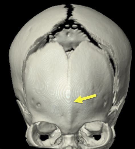 Metopic Suture Synostosis Applied Radiology
