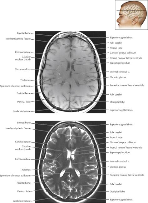 Mri Brain Anatomy