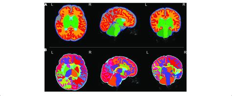 Tissue Segmentation And Neonatal Atlas Parcelation For The Same Download Scientific Diagram