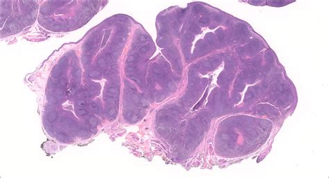 Tonsil Normal Histology Nus Pathweb Nus Pathweb