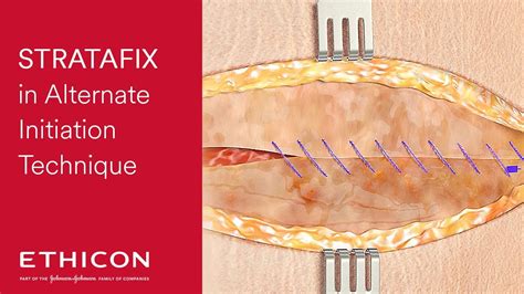 Stratafix Symmetric Pds Plus Alternate Initiation Suturing Technique