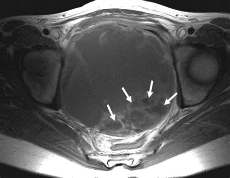 Radiologic Findings Of Peripheral Primitive Neuroectodermal Tumor Arising In The Retroperitoneum