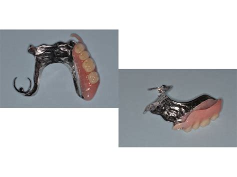 Esthetic Rpd Clasp Design For Anterior Teeth