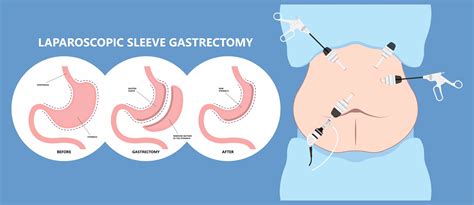Laparoscopic Sleeve Gastrectomy In Turkey Gastric Sleeve
