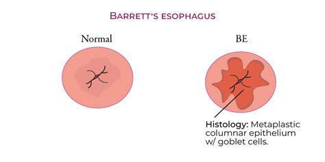 Usmle Comlex Step 1 Glossary Gerd And Barretts Esophagus For Usmle