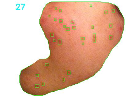 Detect Red Pimples On Face Using OpenCV Closed OpenCV Q A Forum