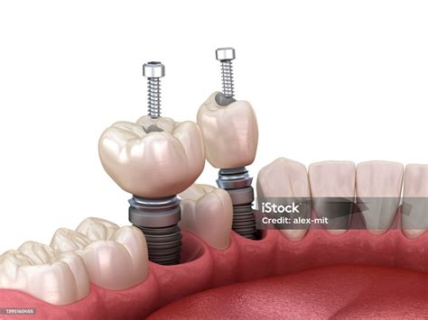 임플란트 나사 고정 위에 전조 및 어음 치아 크라운 설치 치과 치료의 3d 그림 임플란트에 대한 스톡 사진 및 기타 이미지 임플란트 나사 치아 임플란트 Istock