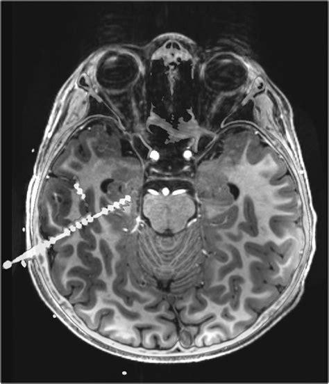 A Patient Undergoing Invasive Eeg Monitoring With Stereotactic Depth