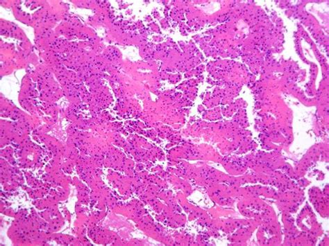 Oncocytic Variant Of Papillary Renal Cell Carcinoma Various Images BosnianPathology
