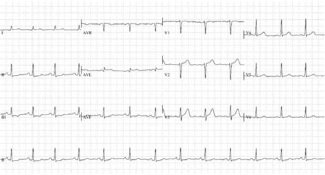 Ecg Monitoring Dr Diana Holdright