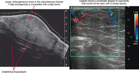 Approach To Bone And Soft Tissue Tumors And Tumor Like Conditions