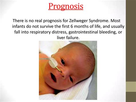 Zellweger Syndrome Pptx
