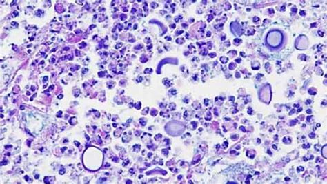 Cryptococcus Neoformans Fungus Britannica