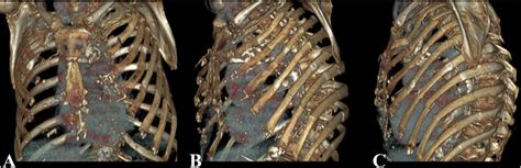 Three Dimensional Ct Scan Reconstructions Showing Multiple Double Or