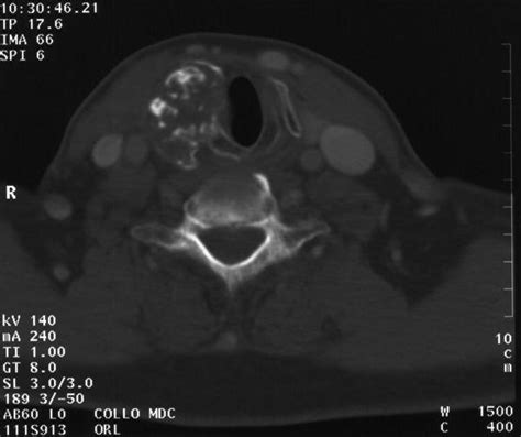 Chondrosarcoma Of The Thyroid Cartilage Eurorad