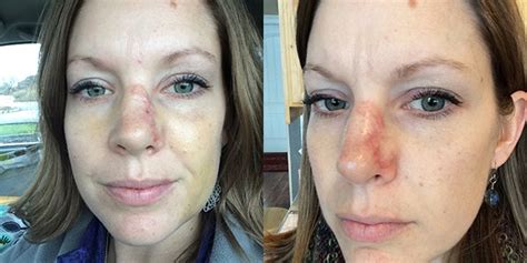 Photos Of ‘scab On Nose That Was Skin Cancer