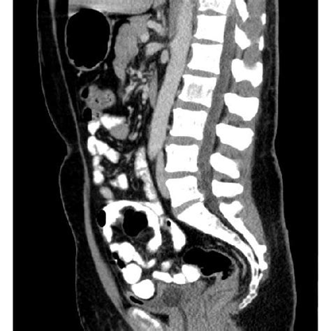 Ct Scan Showing Diffuse Lytic Lesions Throughout The Axial Skeleton