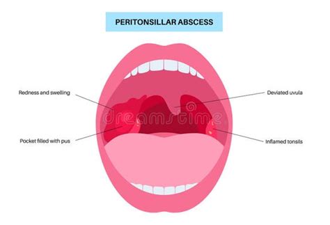 Peritonsillar Abscess Poster Stock Vector Illustration Of Voice