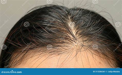 Close Up Reveals Male Pattern Baldness Showcasing The Effects Of Hair Loss On The Scalp Stock