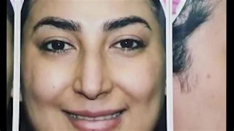 عمل نیمه فانتزی بینی استخوانی دکتر امید ابراهیمی نماشا
