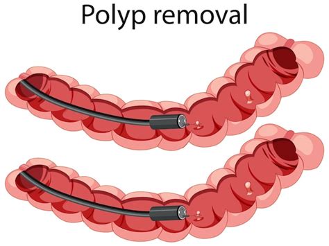 Polyp Morphology Vectors And Illustrations For Free Download