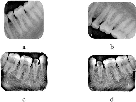 Figure 1 From Automatic Lesion Detection In Periapical X Rays Semantic Scholar